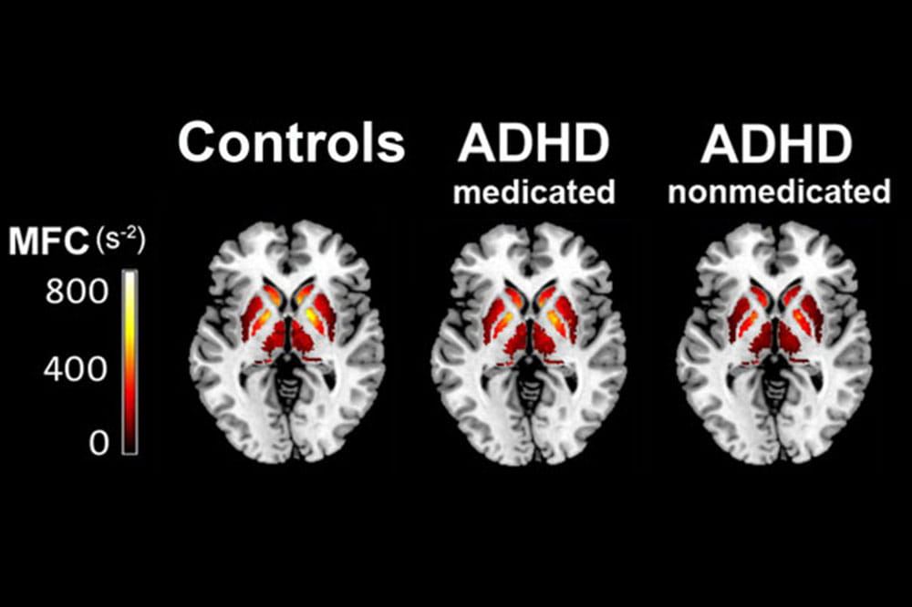 MRI Technique May Help Prevent ADHD Misdiagnosis MUSC Health